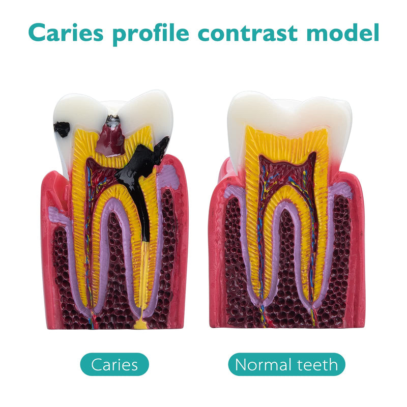 Dental Caries Teeth Model - Anatomy Education Model Caries Bilateral C ...