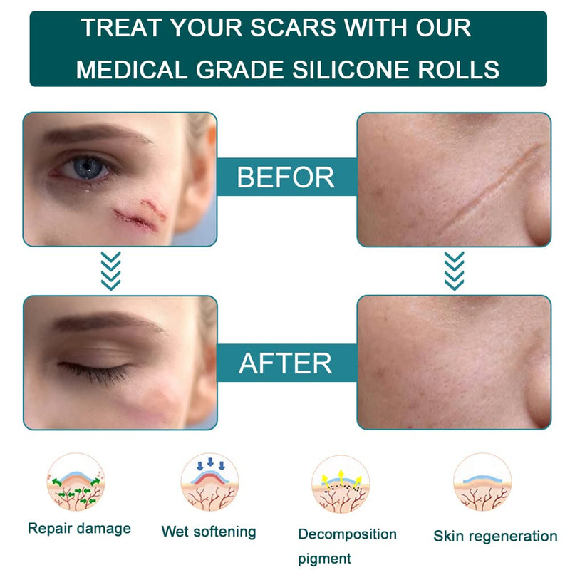 SHEEYOON Silicone Scar Sheets, Silicon Scar Tape Roll，Medical Grade Si ...